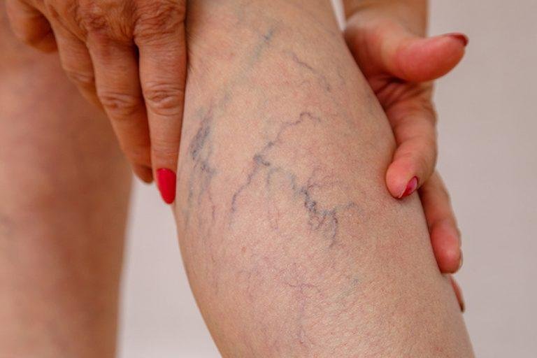 Sclerotherapy - Veins Injection | Sci-u Clinic Wilmslow